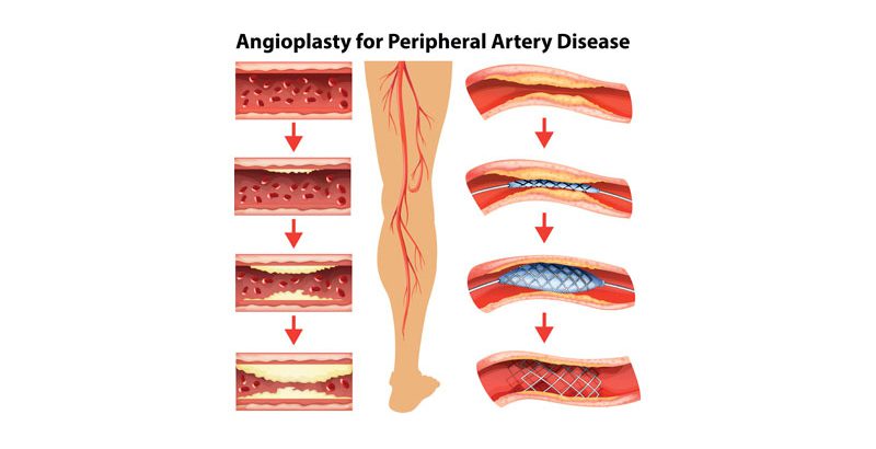 Peripheral Artery Disease Rock Hill, SC | Carolina Cardiology Associates